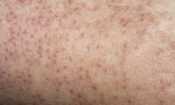 How to Treat your Child’s Keratosis Pilaris or “Chicken Skin” Naturally ...