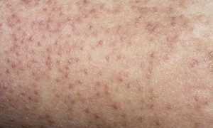 How to Treat your Child’s Keratosis Pilaris or “Chicken Skin” Naturally ...